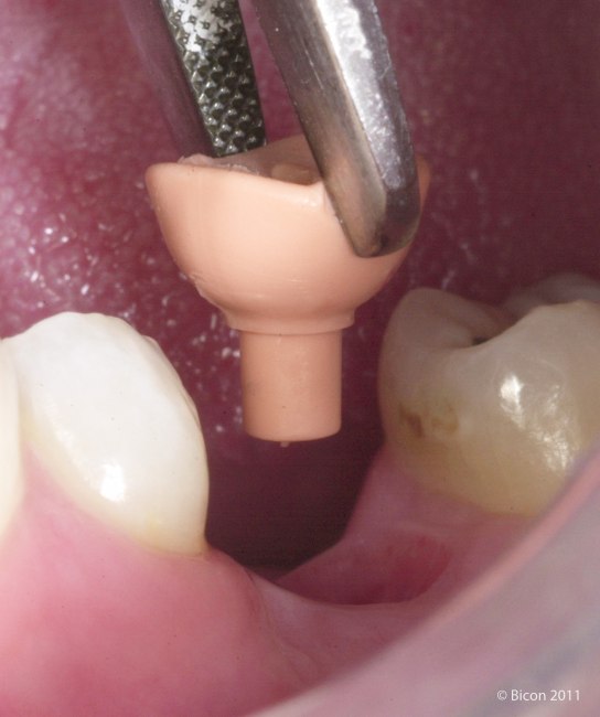 Dental Implant Center Roma | Un impianto Bicon Short post-estrattivo ...