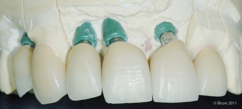 Dental Implant Center Roma | 6 impianti Bicon post-estrattivi - Dental ...
